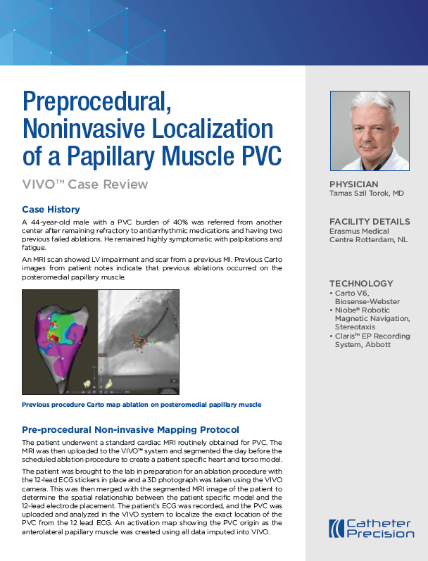 Pre-procedural Noninvasive Localization of a Papillary Muscle PVC